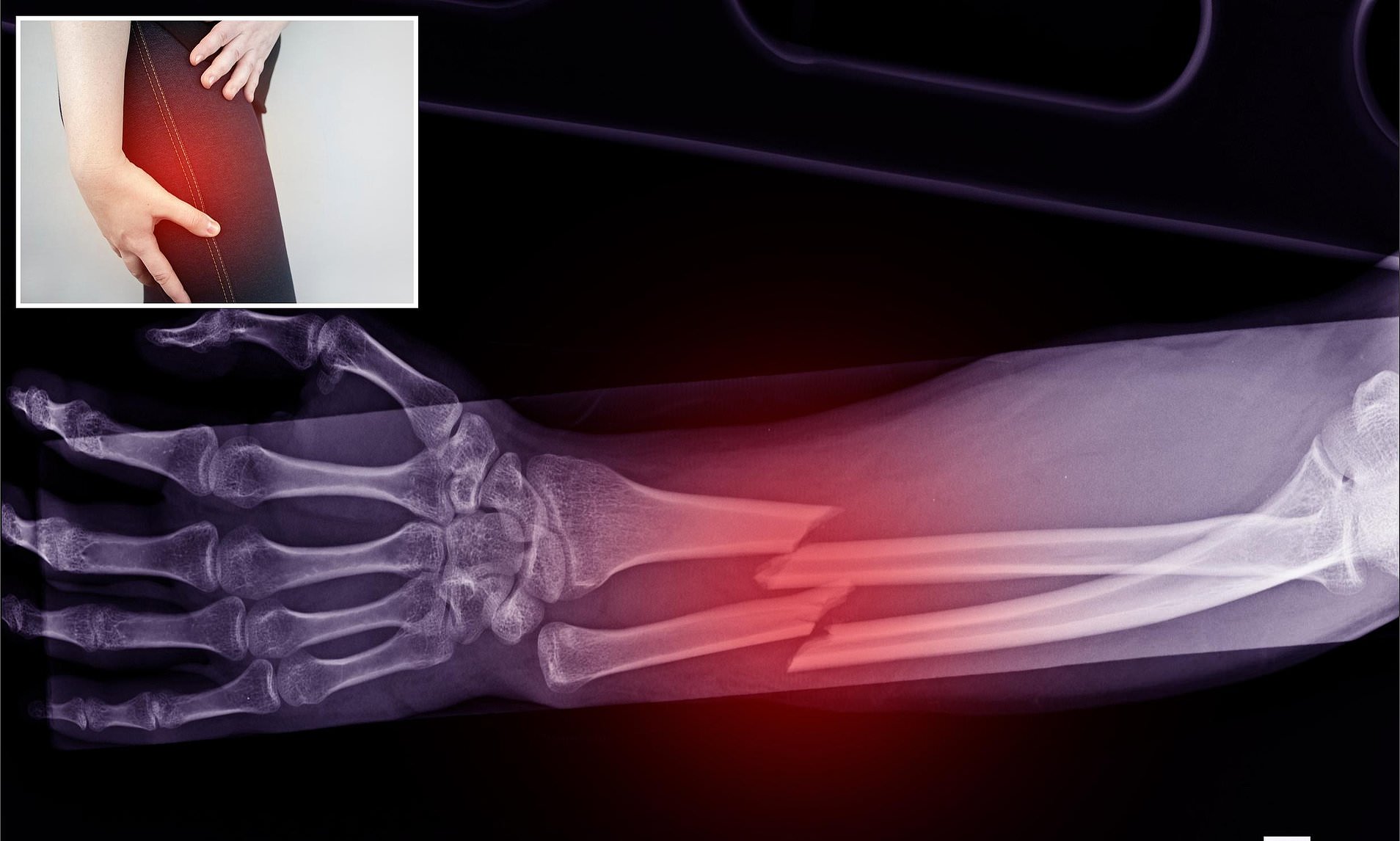 Broken bones caused by osteoporosis cost British economy more than £142 ...