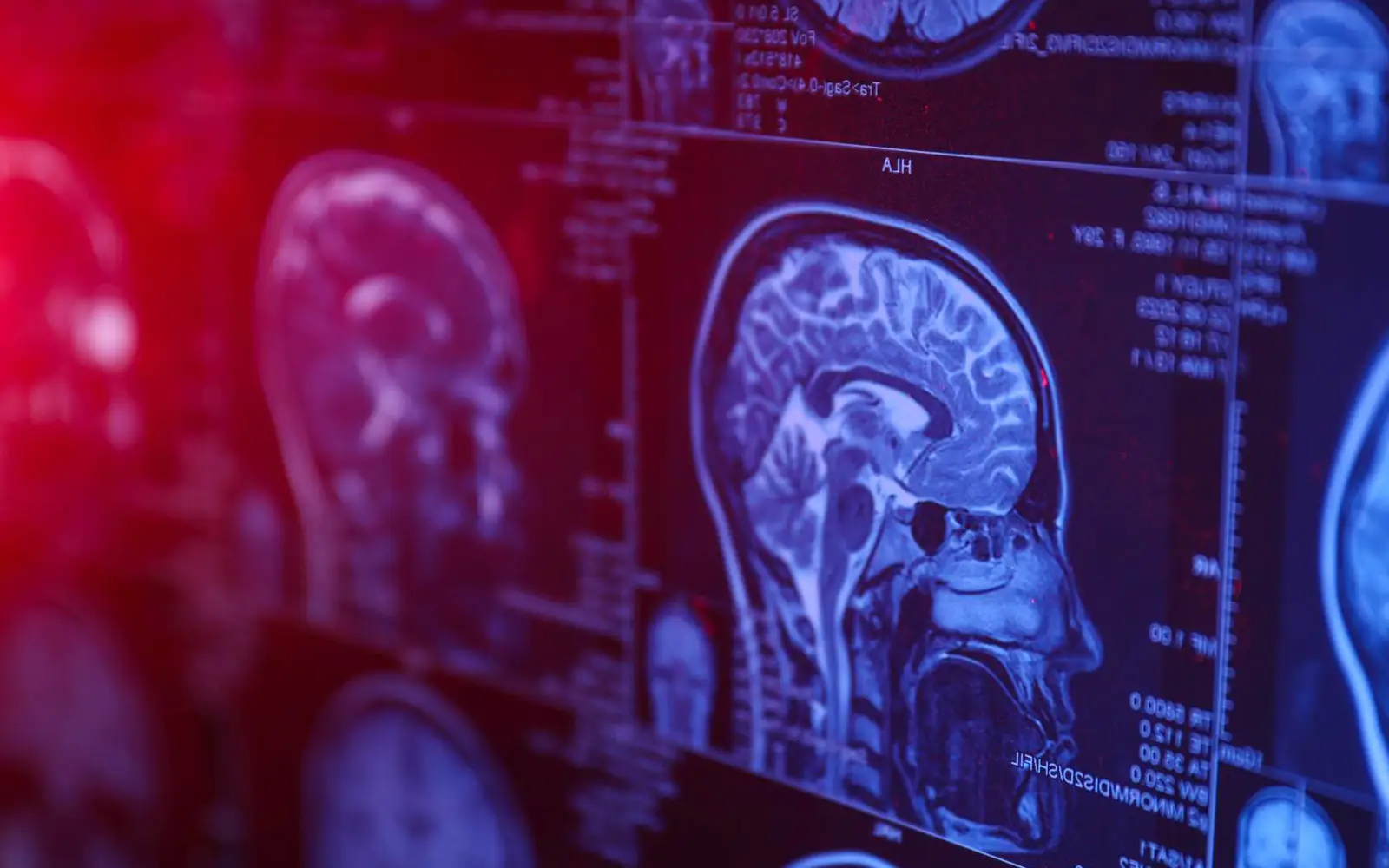 The little-known link between climate change and brain health