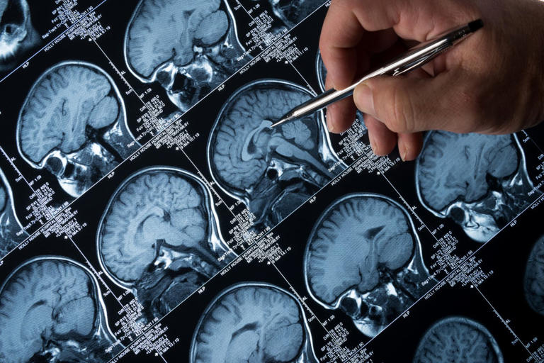 Scientists make Alzheimer’s breakthrough during cat study