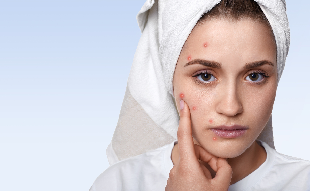 Adiós granitos: los pimple patches que triunfan en Amazon por solo 3 euros