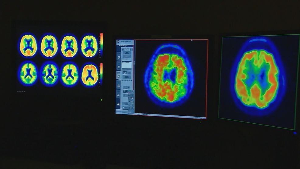 Creatine's role in brain health: What it means for Alzheimer's patients