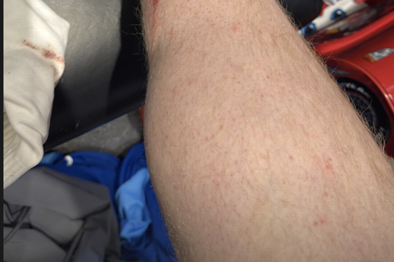 Soccer Aid row as Angry Ginge blasts Carlos Tevez and shows off bloody ...