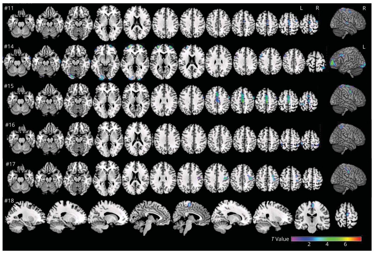 Motor cortex identified as origin of Lance-Adams syndrome