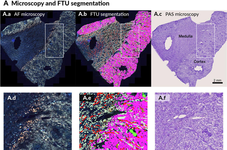 Kidney atlas maps molecular landscape, unlocking clues to renal health ...