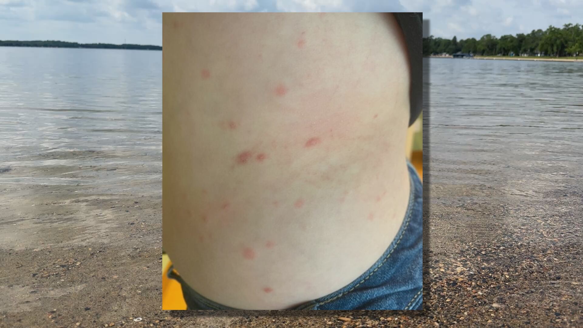 Swimmer’s Itch labeled health crisis in Lakes Country