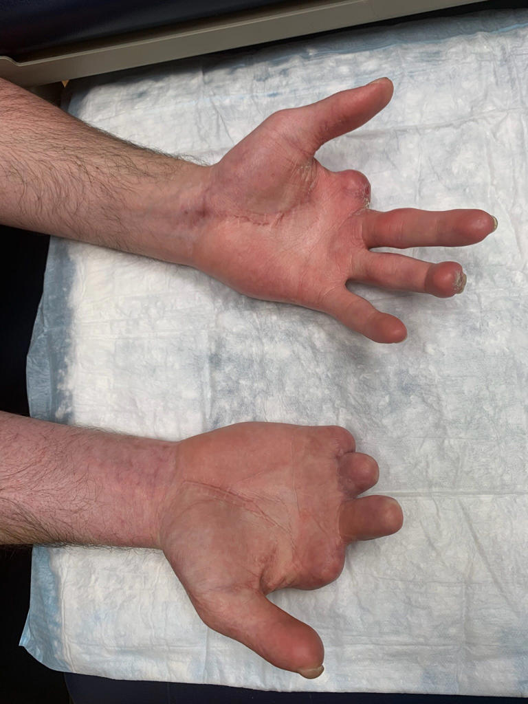 Jury awards man millions after losing fingers when refrigerant explodes ...