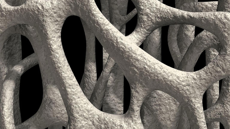 Picking the Right Osteoanabolic Agent First, and What Comes Next