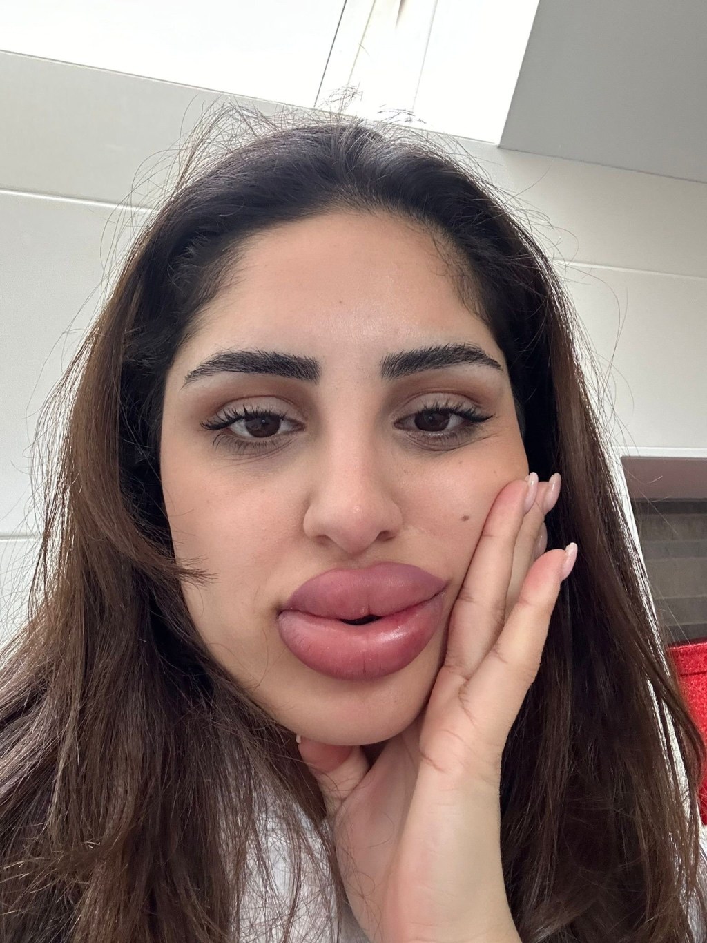 My lip filler dissolving treatment went horribly wrong — and left me ...