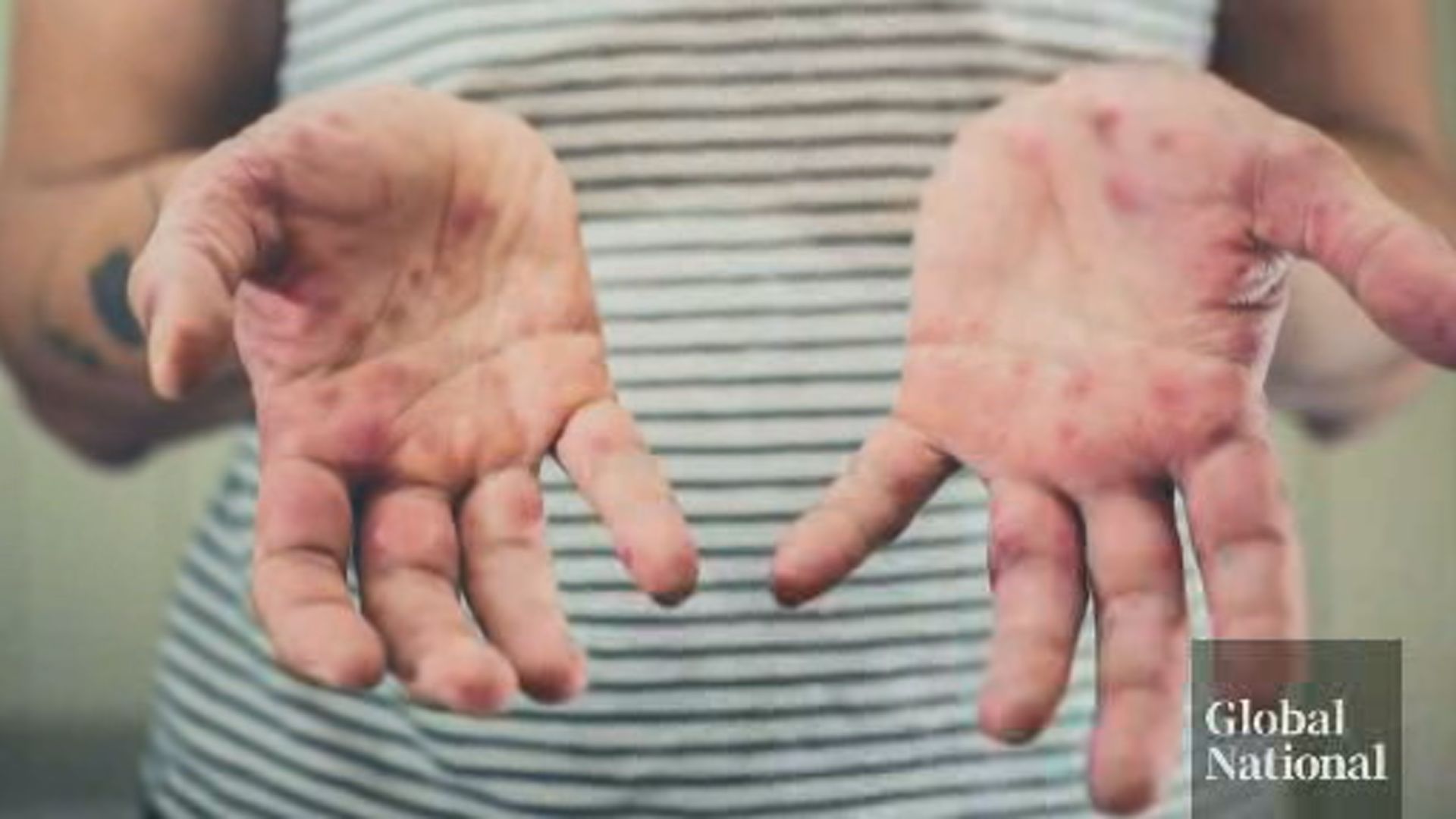 Infant dies in Ontario after measles infection, other complications