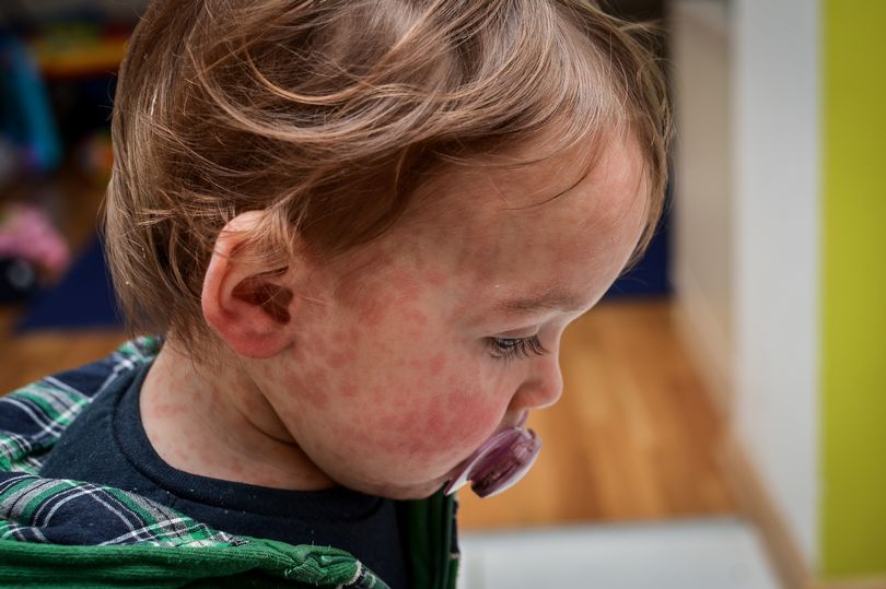 UKHSA issues vaccine plea as 'too many' children not protected against ...