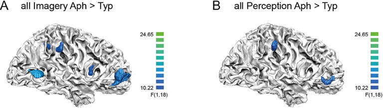 Aphantasia might be linked to alterations in brain connectivity