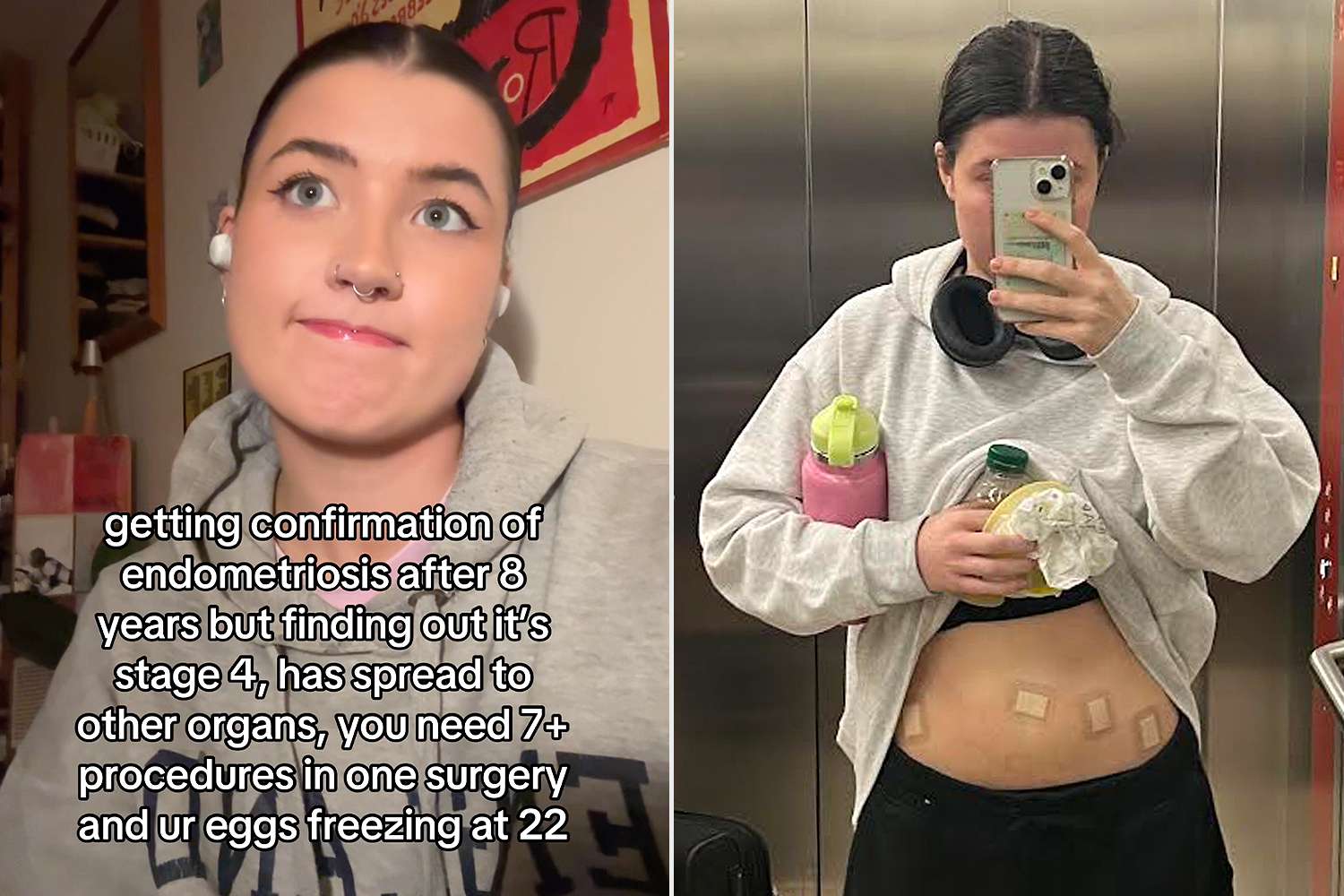 Woman, 22, Forced to Freeze Eggs After Stage 4 Endometriosis Diagnosis: 'I Don't Even Know If I ...