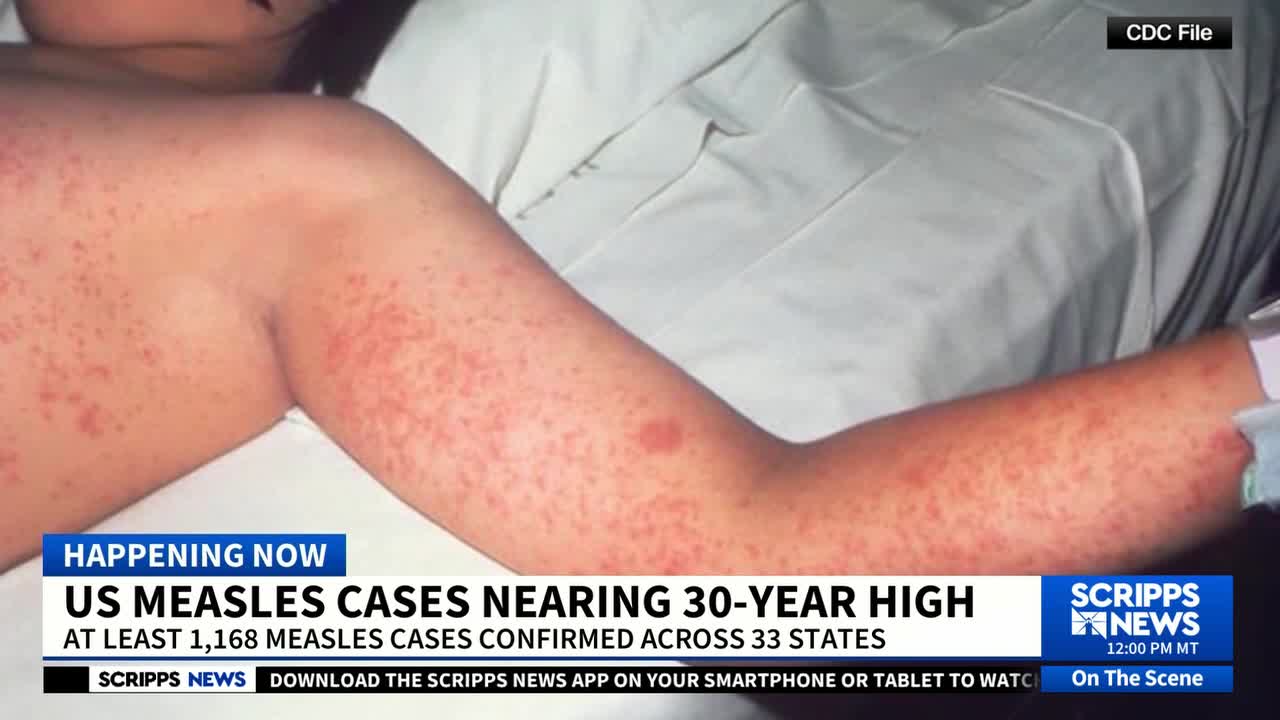 US measles cases near 30-year high
