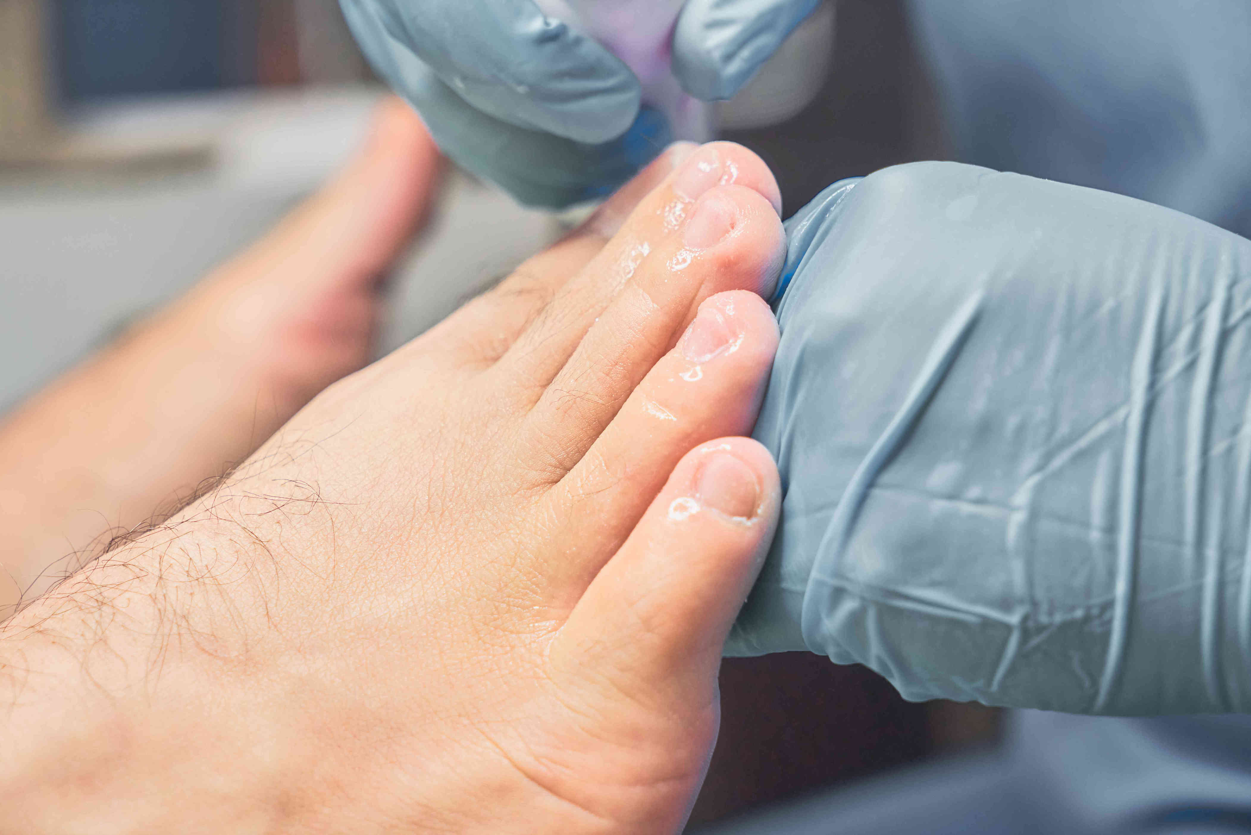 What To Know About Onycholysis (Nail Separation)