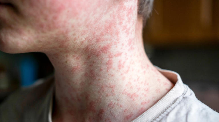 Flying Now Puts You At Risk Of Measles Exposure, CDC Says