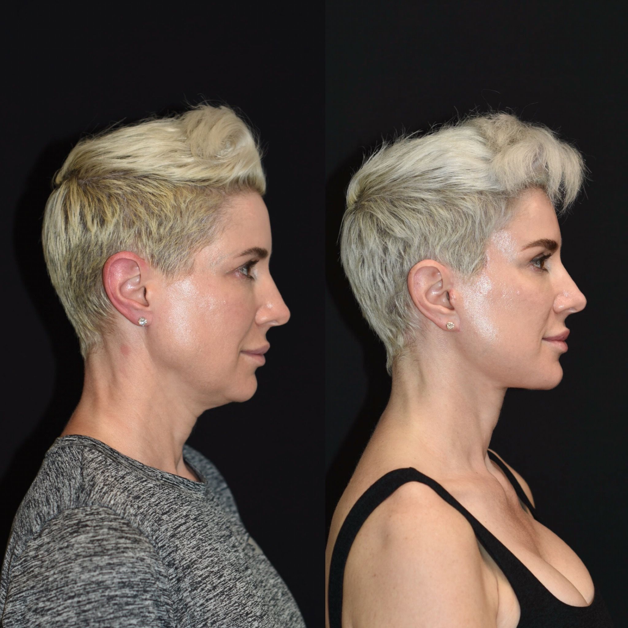 The "Glow-Up" Facelift Is Real