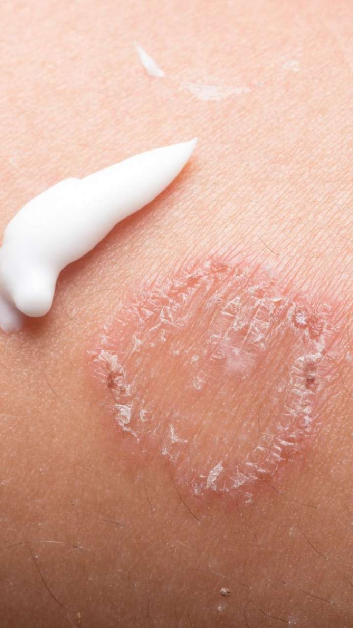 What Causes Ringworm In Children?