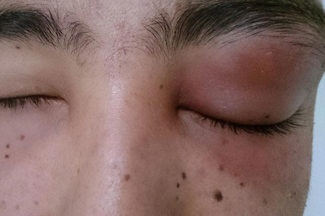 What Is Periorbital Cellulitis? Symptoms, Causes, and Treatment