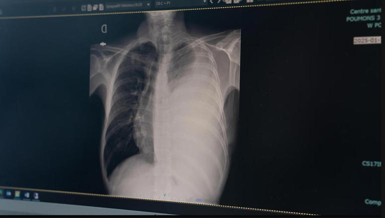 Q+A | Nunavik's tuberculosis outbreaks are a result of decades of ...