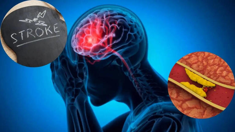 Subtle, Unexpected Signs of Brain Clot That May Appear Weeks Before A Stroke