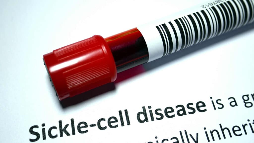 Sickle cell disease: What you need to know about SCD