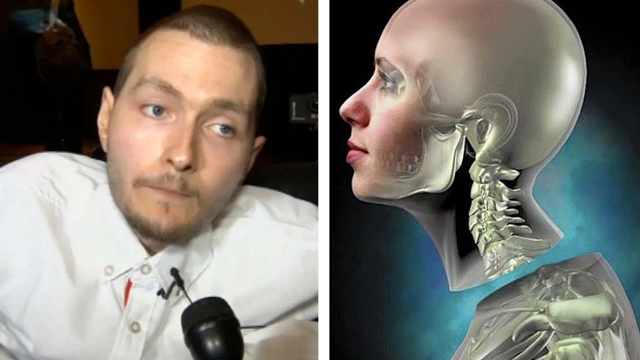 What Happened to the World’s First Human Head Transplant?