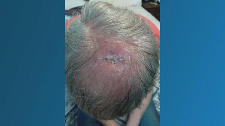 One in five people will get skin cancer in their lifetime. Here's how ...