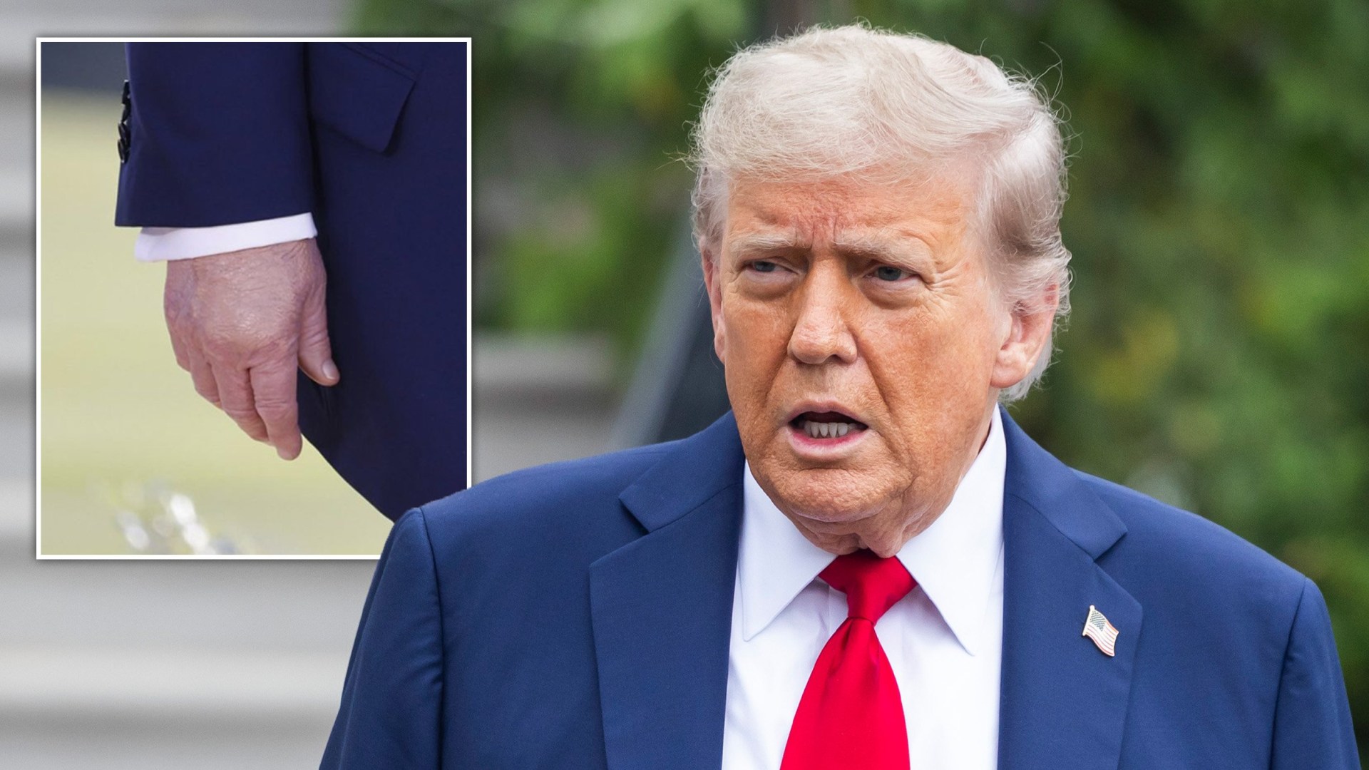 Donald Trump's hand mark and 'cover up' raises concern