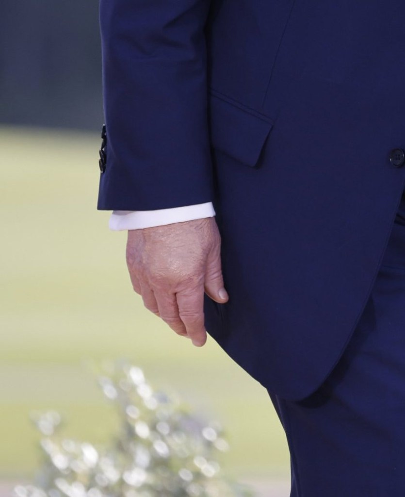 Donald Trump’s hand mark and ‘cover up’ raises concerns, again