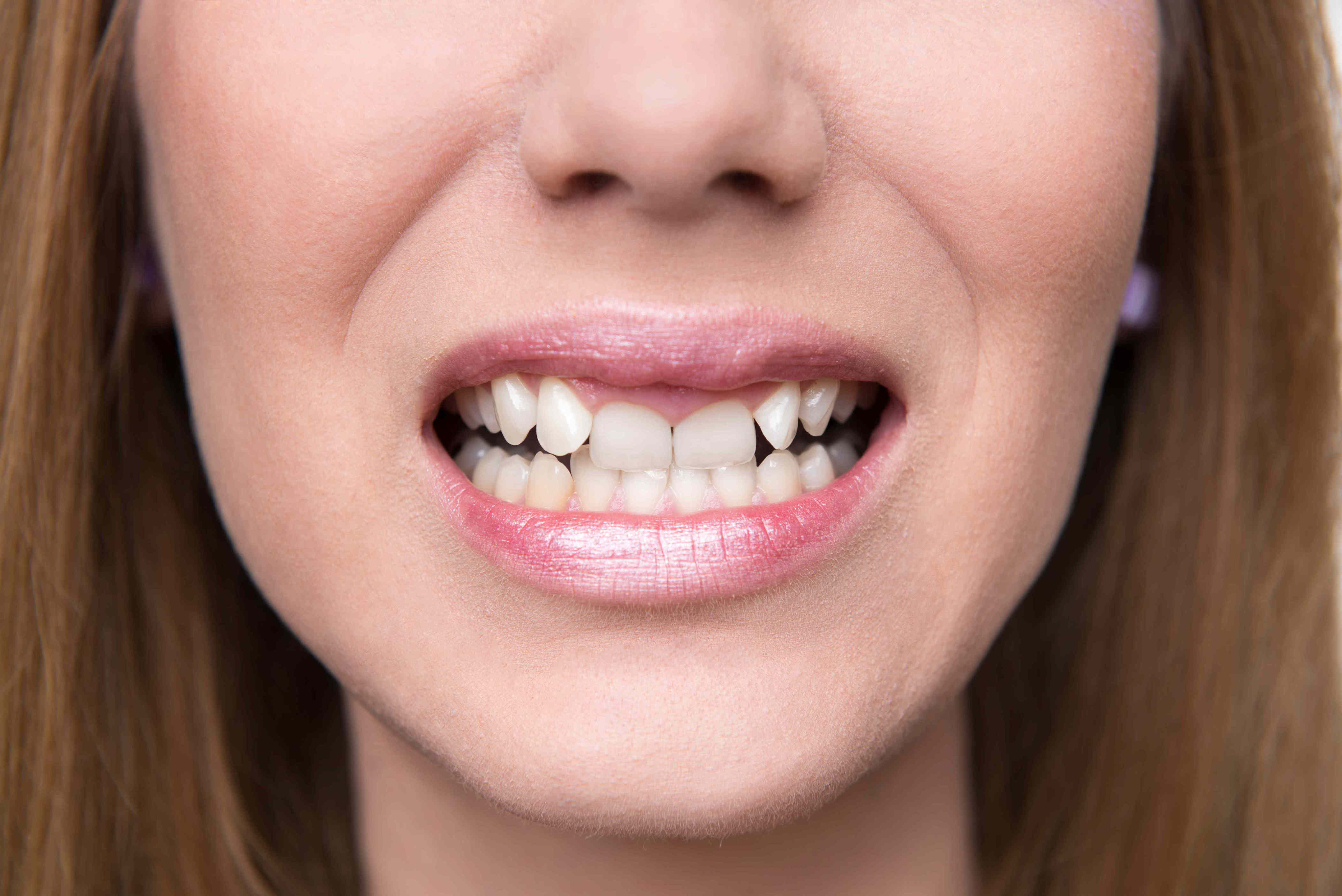 8 Causes of Crooked Teeth and How to Straighten Them
