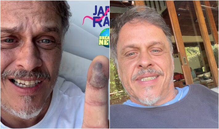Guilherme Fontes mostra dedo roxo após picada de cobra: ‘Não sinto nada ...