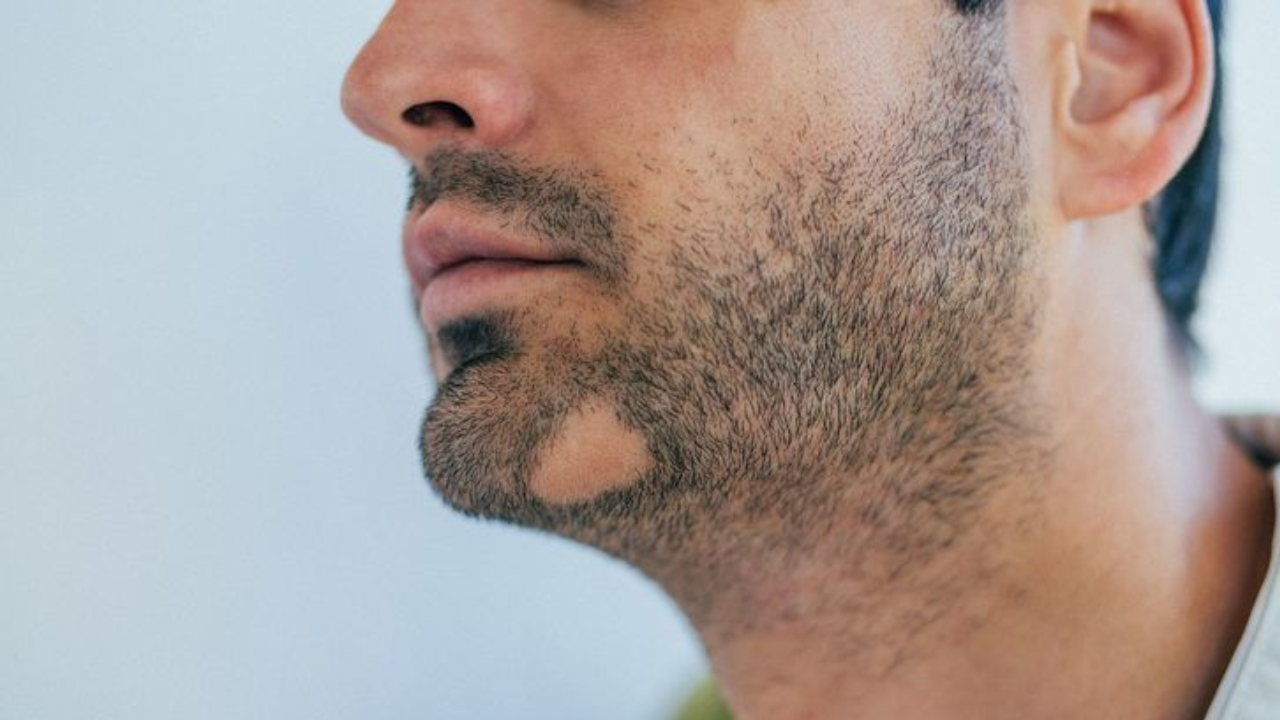 5 simple beard mask recipes to cover the unsightly bald patch