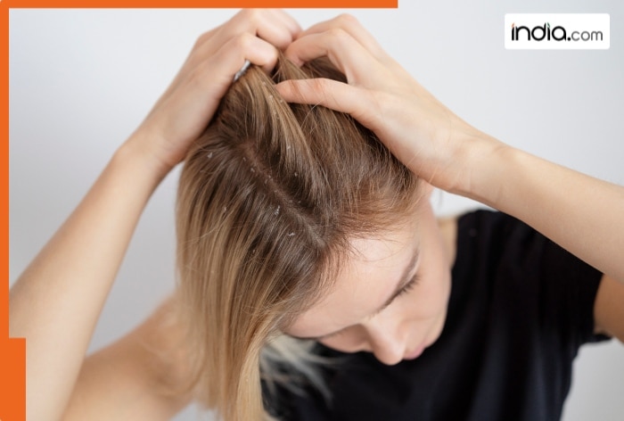 7 home remedies to get rid of dandruff and itchy scalp naturally
