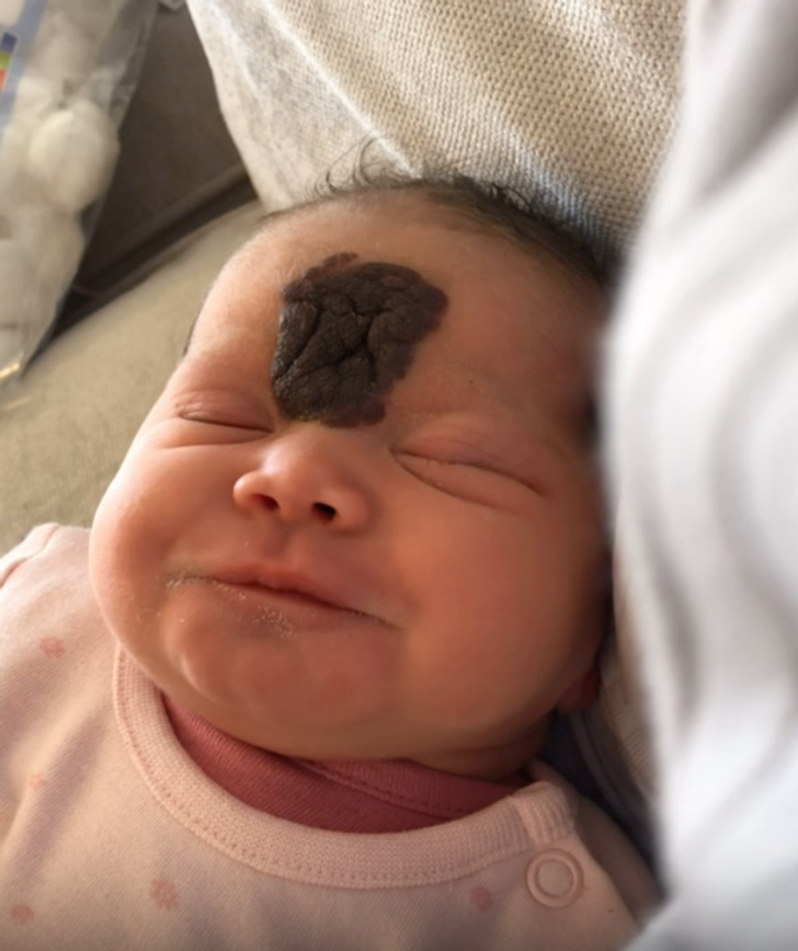“We Got Stares,” Parents Chose to Remove Their Daughter’s Rare ...