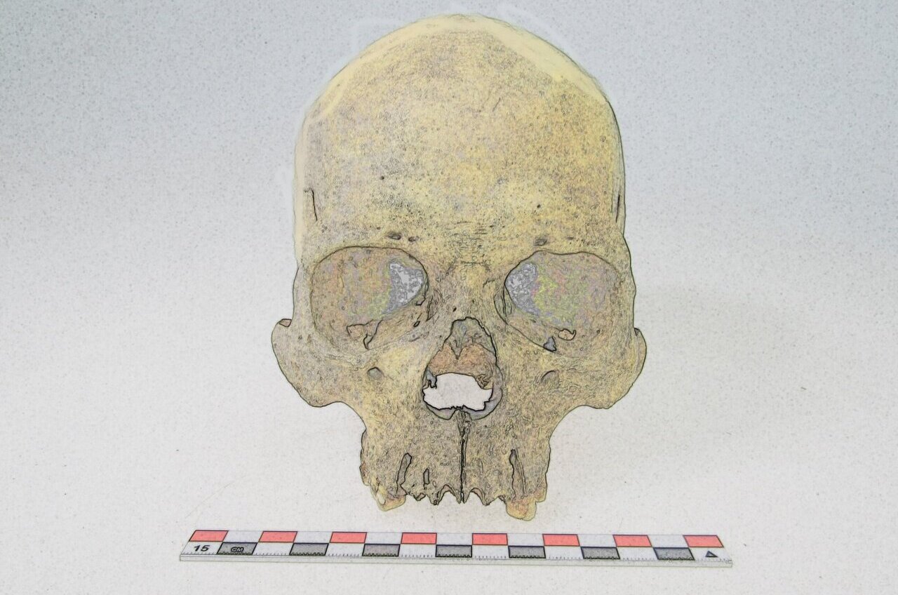 Ancient DNA reveals rare leprosy strain existed in the Americas for ...