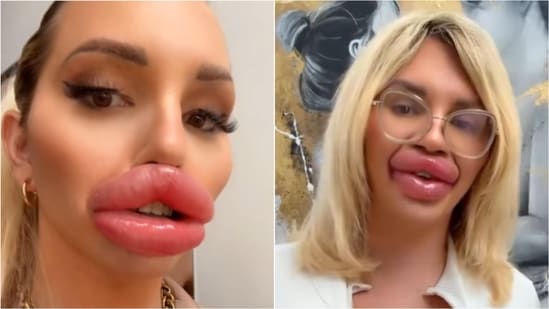 Spanish woman spends ₹1.45 crore on 'momo-like' lips; struggles to eat ...
