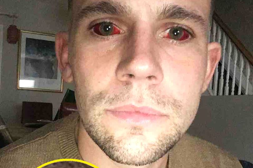 'Five-day bender left my eyes so bloodshot, people thought I was the devil'