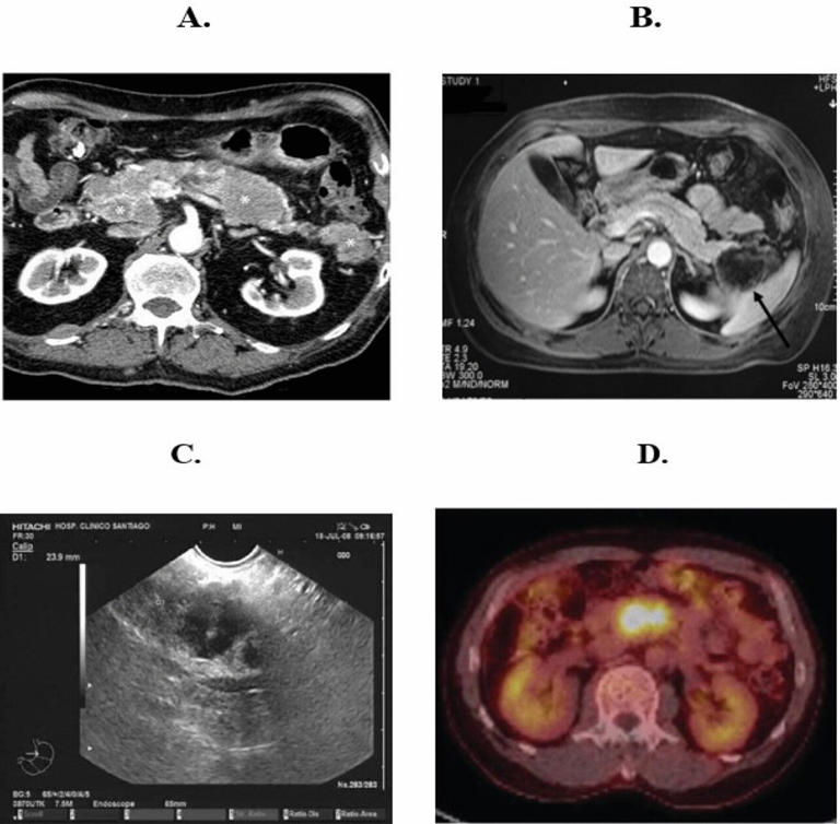 AI models could spot pancreatic cancer at an early stage and predict ...