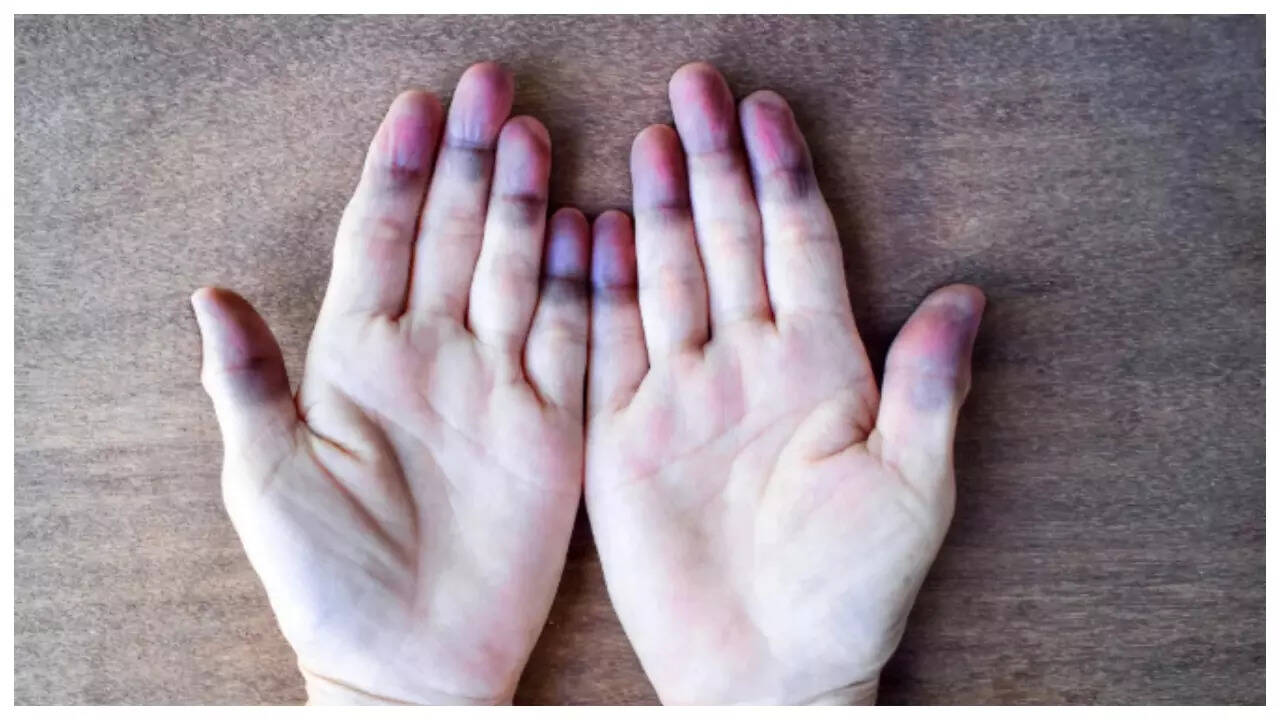 Heart Disease: 7 warning signs that appear on the skin