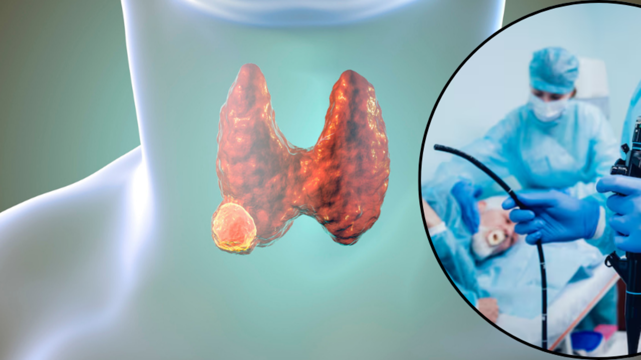 Simple Capsule Sponge Test Can Replace Endoscopies And Make Cancer ...