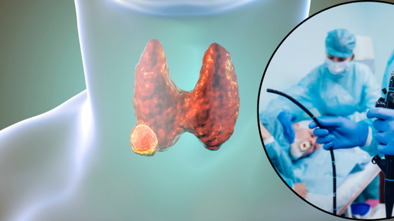Simple Capsule Sponge Test Can Replace Endoscopies And Make Cancer ...