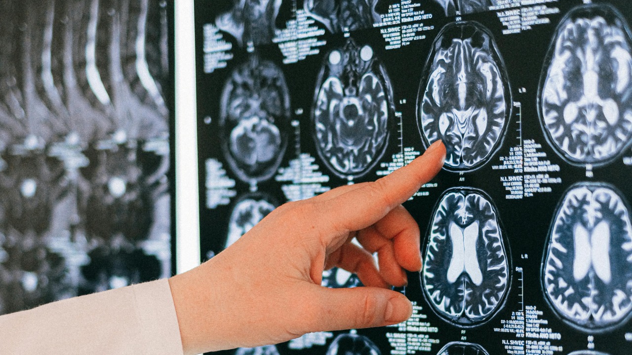 Tech Addiction Is Reshaping Your Brain—Proof From MRI Scans