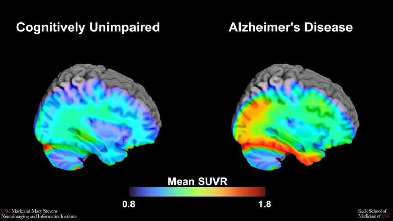 Scientists Find "Critical" New Brain Scan That Can Spot Alzheimer's Early