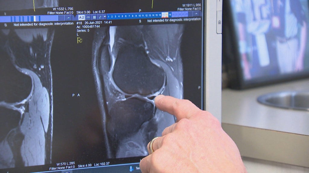 Less invasive knee procedure uses patient's own cells to repair ...