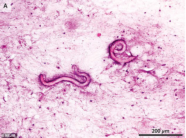 Men become infested with parasites after receiving infected organs ...