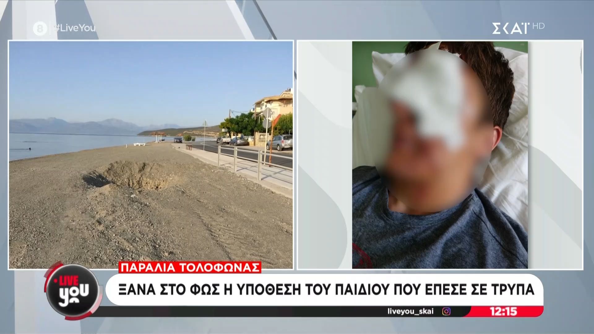 Παραλία Τολοφώνος: Ξανά στο φως η υπόθεση του παιδιού που έπεσε σε τρύπα