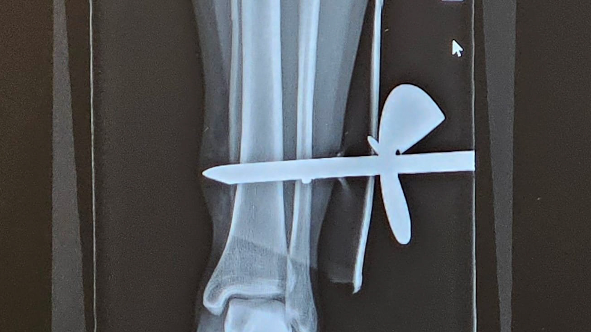 Woman impaled by metal spike while mowing lawn