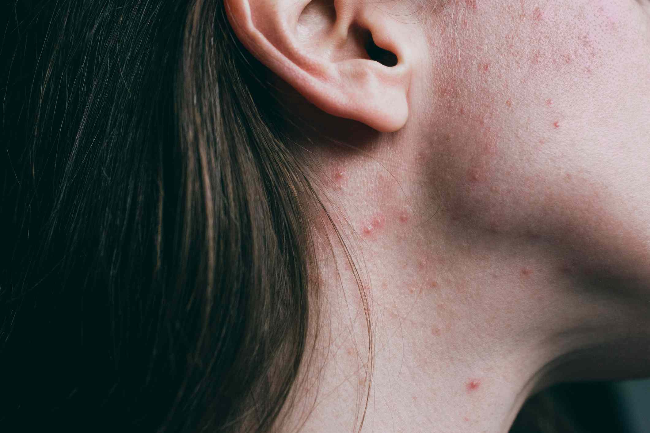 What causes neck acne—and how can you get rid of it?