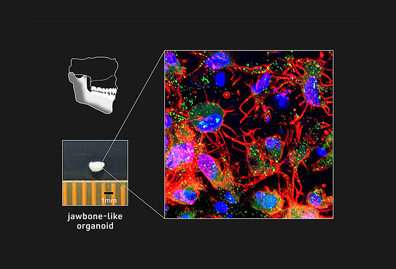 Jawbone organoids from patient iPS cells model bone disease and therapy ...