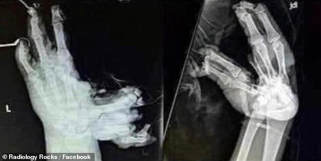 Disturbing X-rays reveal the horrors of lighting off fireworks on the ...